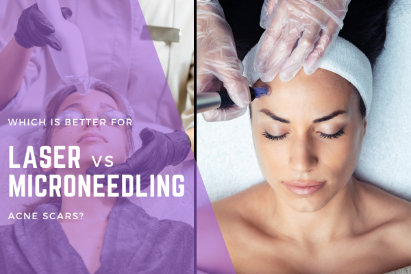 Microneedling vs. Laser Treatment for Acne Scars: Which is Right for You?